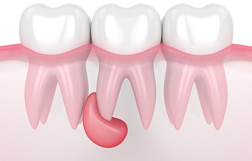 Résection apicale à Toulouse - Exérèse d’un kyste, Dentiste Toulouse